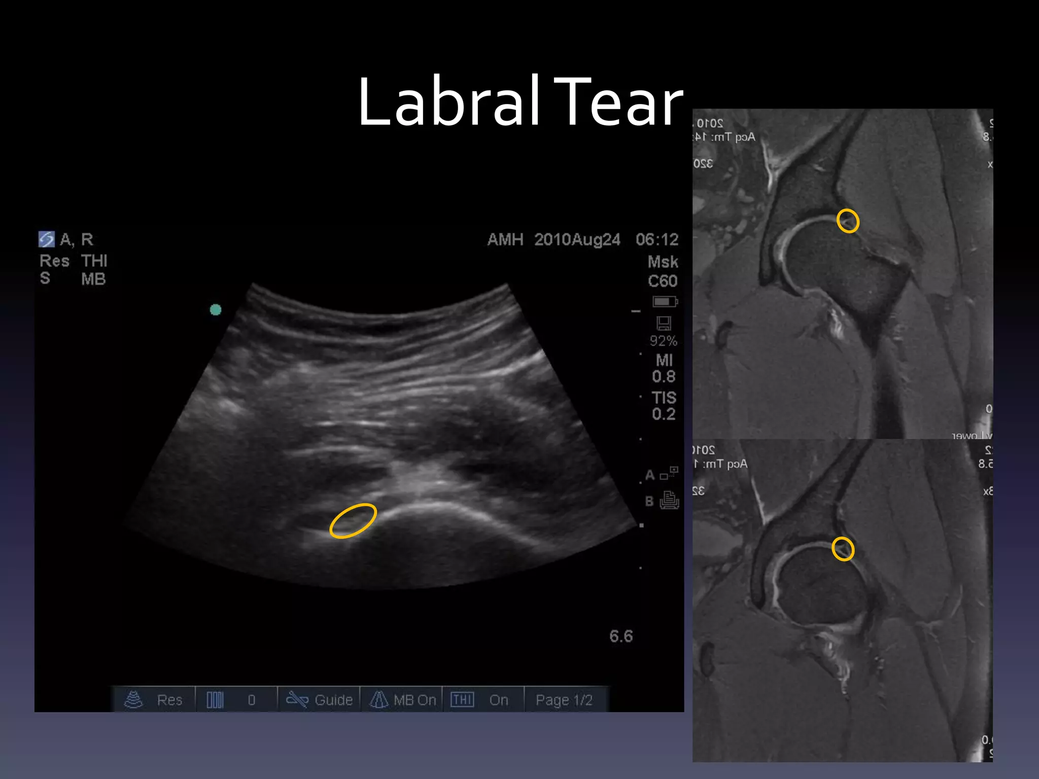 Ultrasound - Hip | PDF