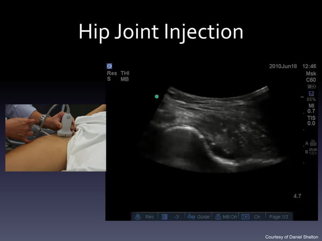 Ultrasound - Hip | PPT