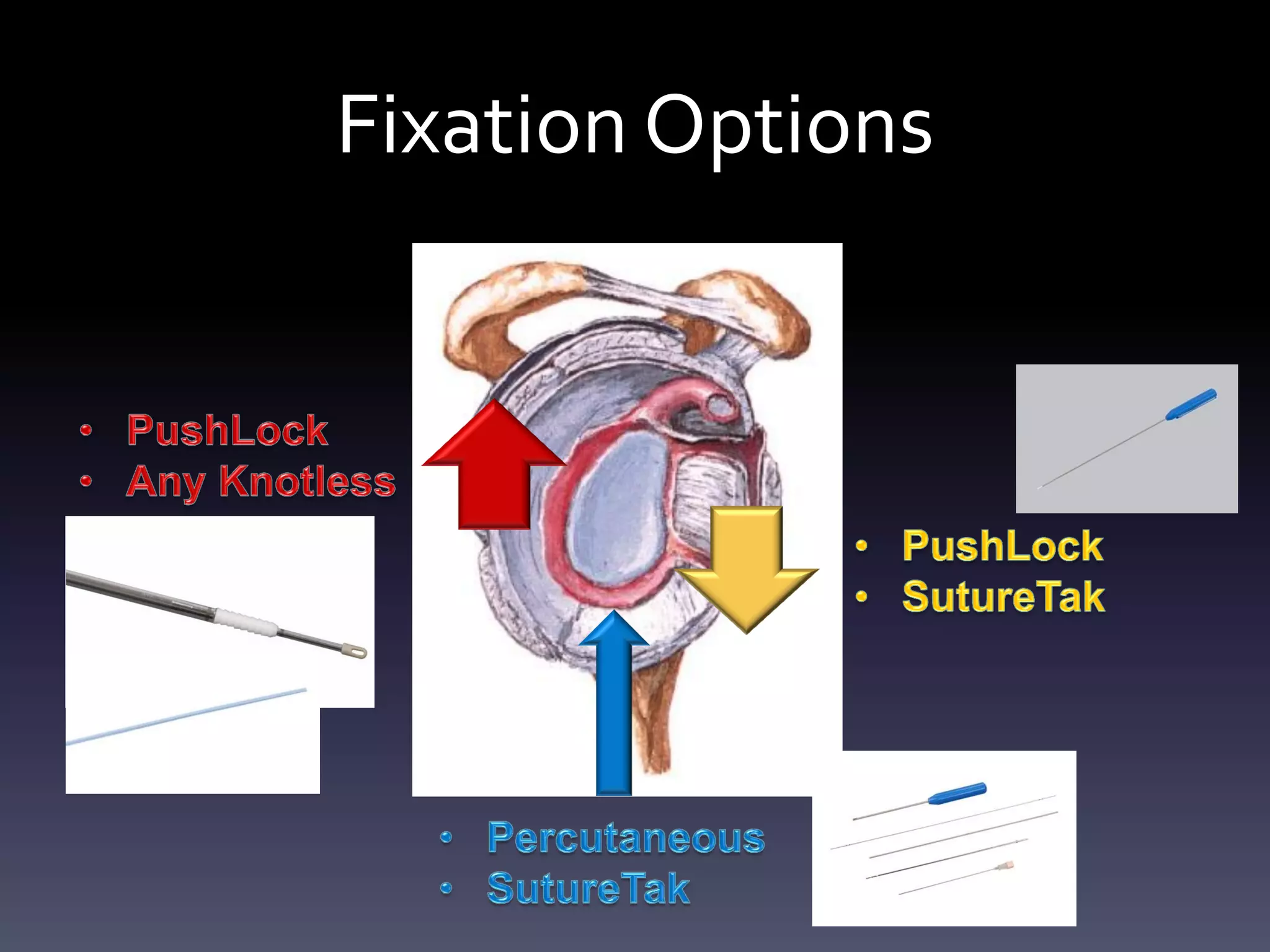 Posterior Instability | PDF