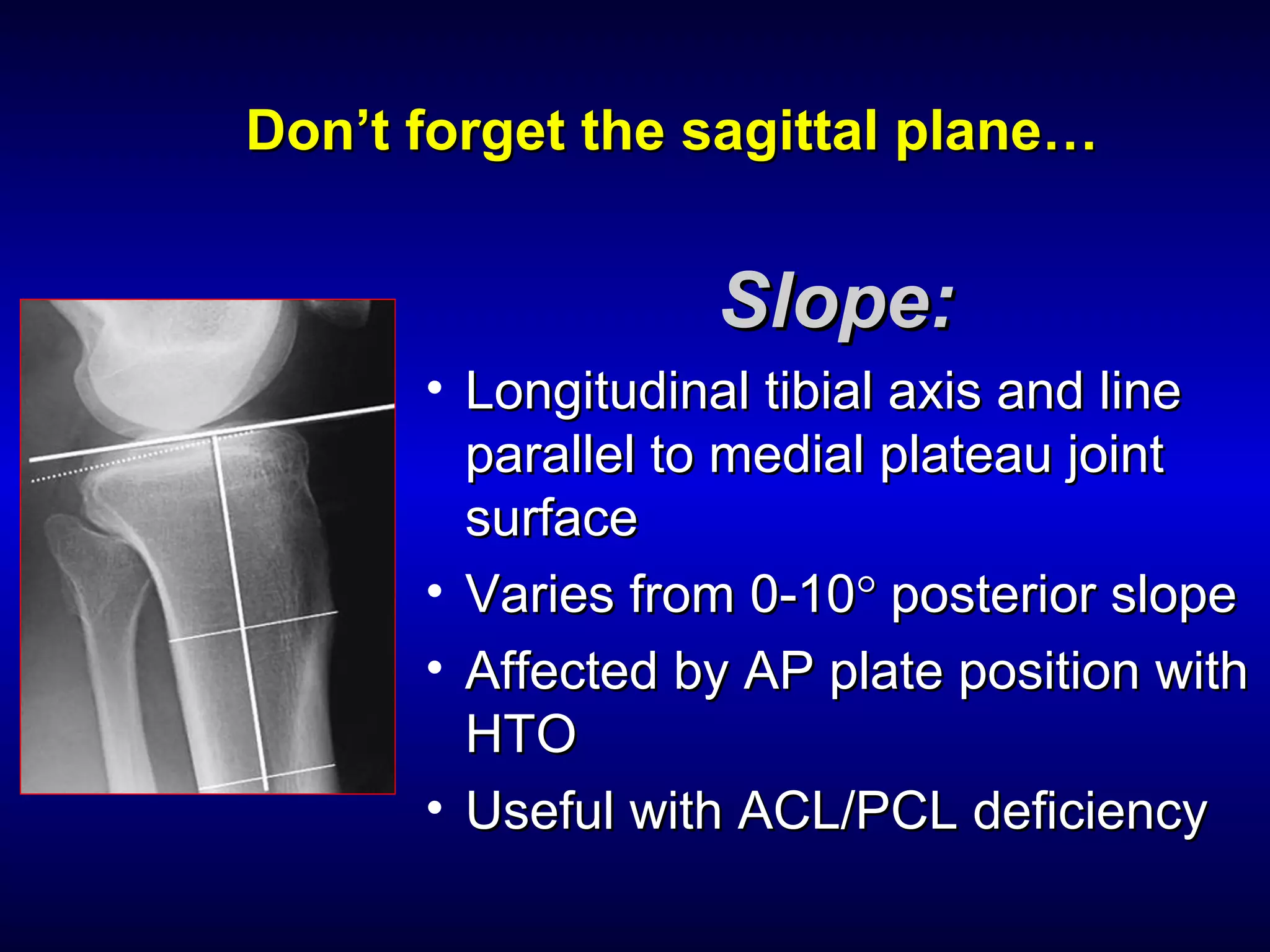 Medial Opening Wedge High Tibial Osteotomy | PPT