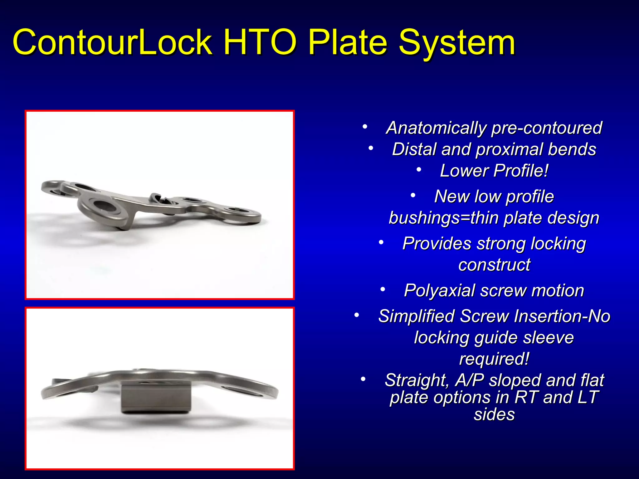 Medial Opening Wedge High Tibial Osteotomy | PPT