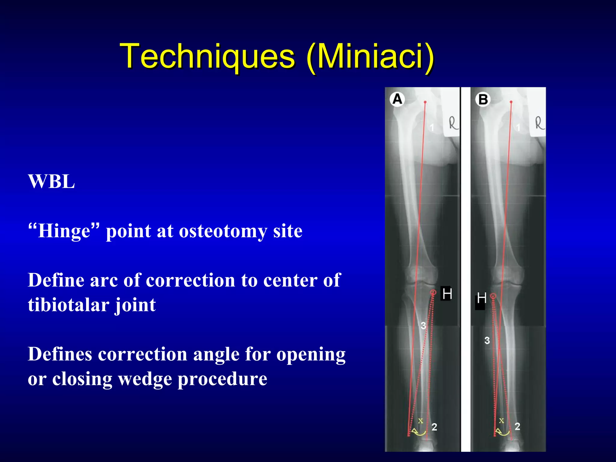 Medial Opening Wedge High Tibial Osteotomy | PPT