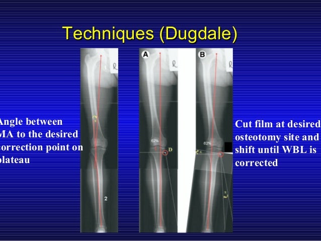 Medial Opening Wedge High Tibial Osteotomy