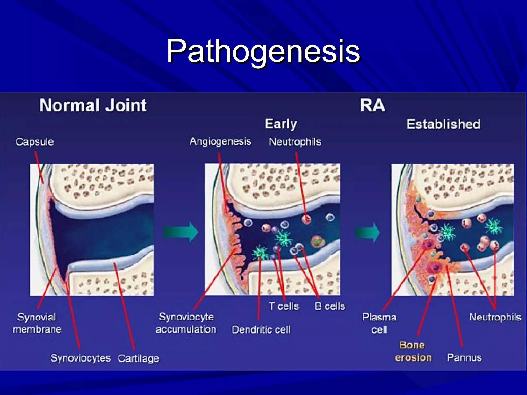 Arthritis | PPT