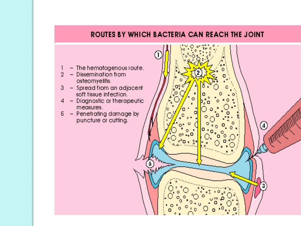 Septic Arthritis