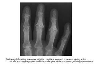 Diagnostic Imaging of Arthritis | PPT