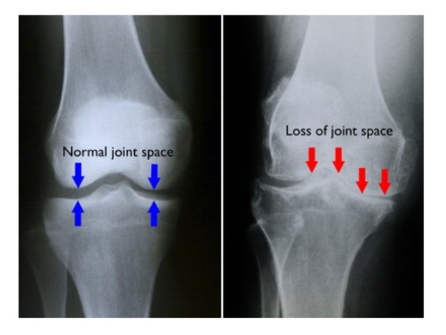 Diagnostic Imaging of Arthritis