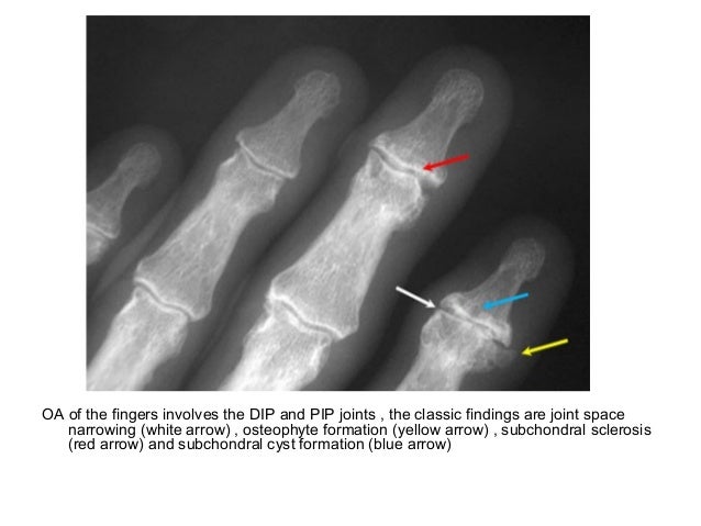 Diagnostic Imaging of Arthritis