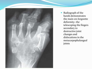 Radiological evaluation of Arthritis | PPTX
