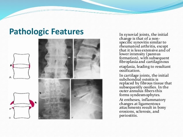 Radiological evaluation of Arthritis
