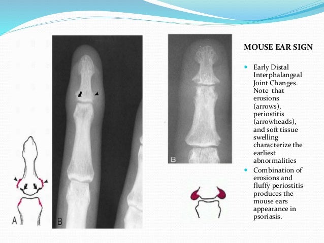 Radiological evaluation of Arthritis