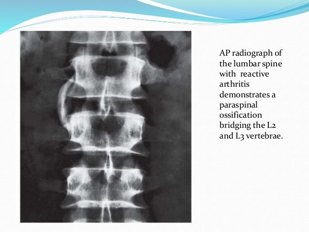 Radiological evaluation of Arthritis