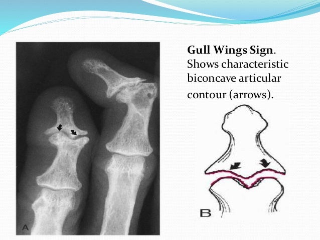 Radiological evaluation of Arthritis