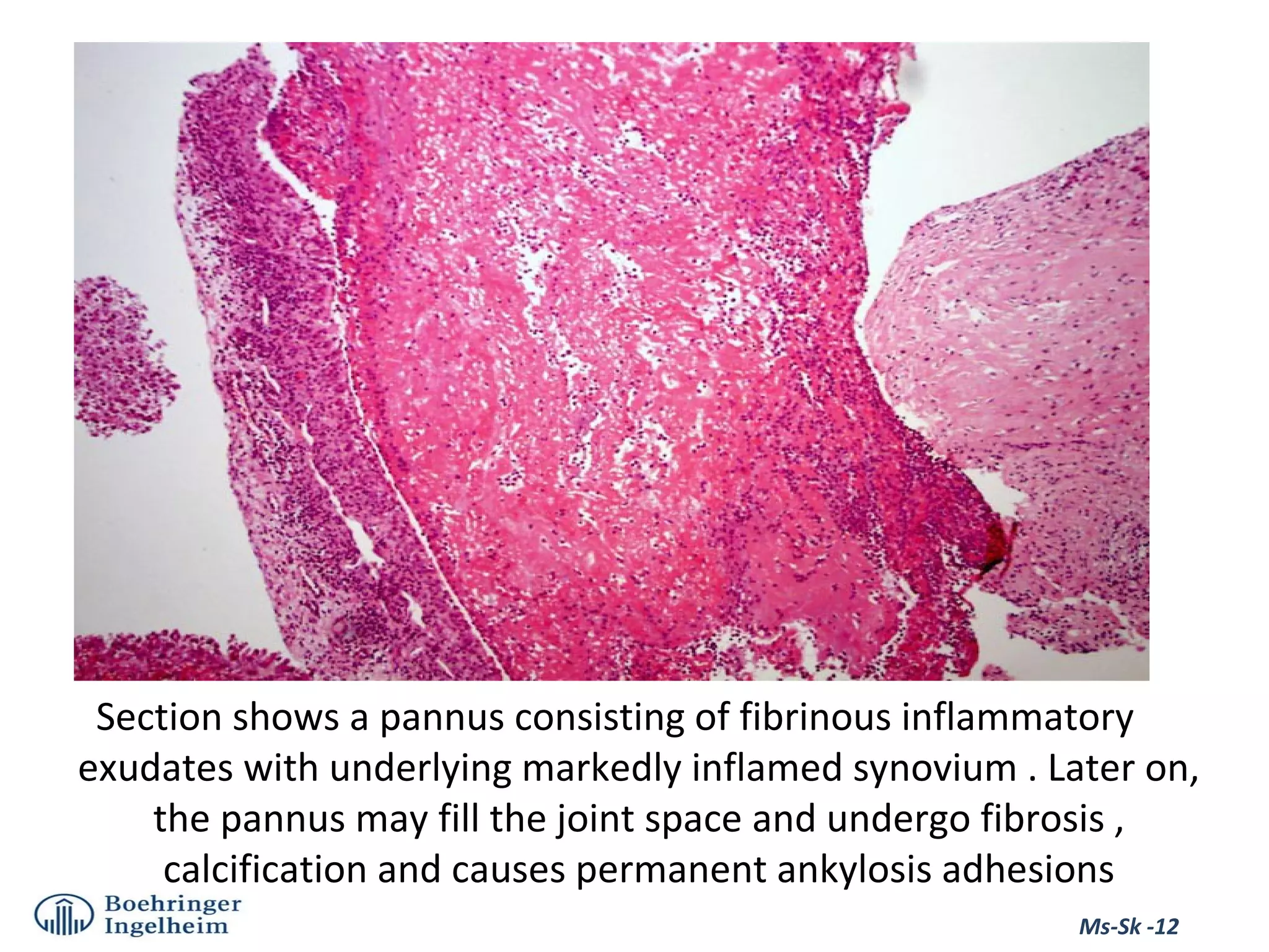 Arthritis | PPT