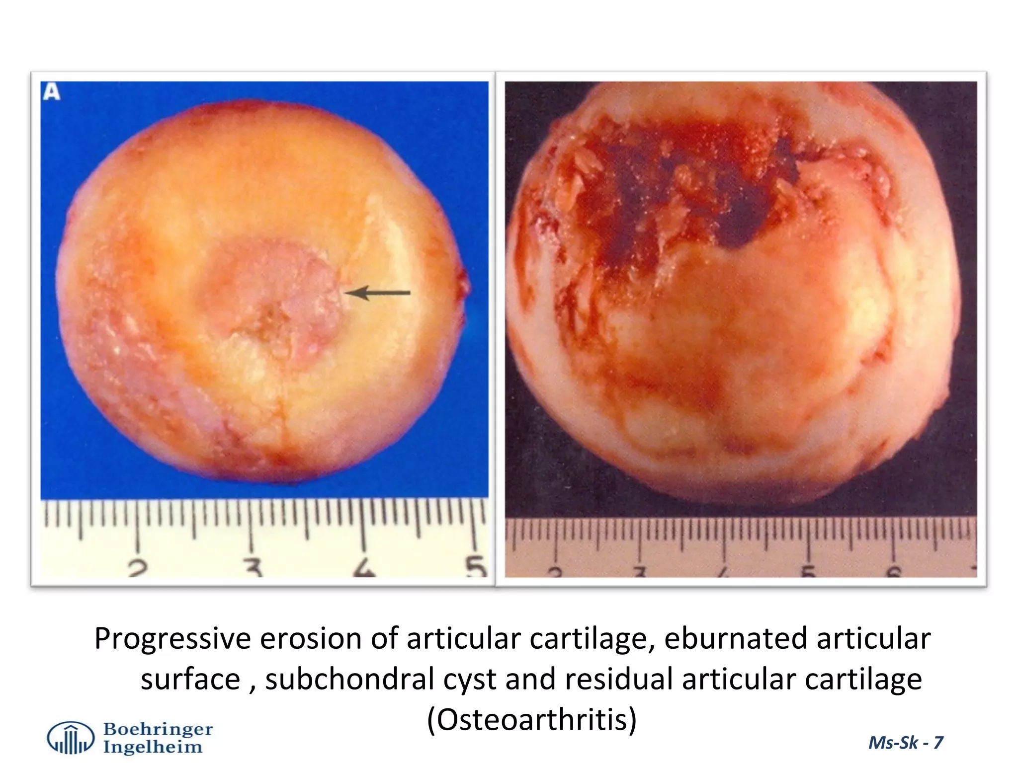 Arthritis | PPT