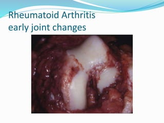 ARTHRITIS.pptx