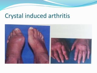ARTHRITIS.pptx