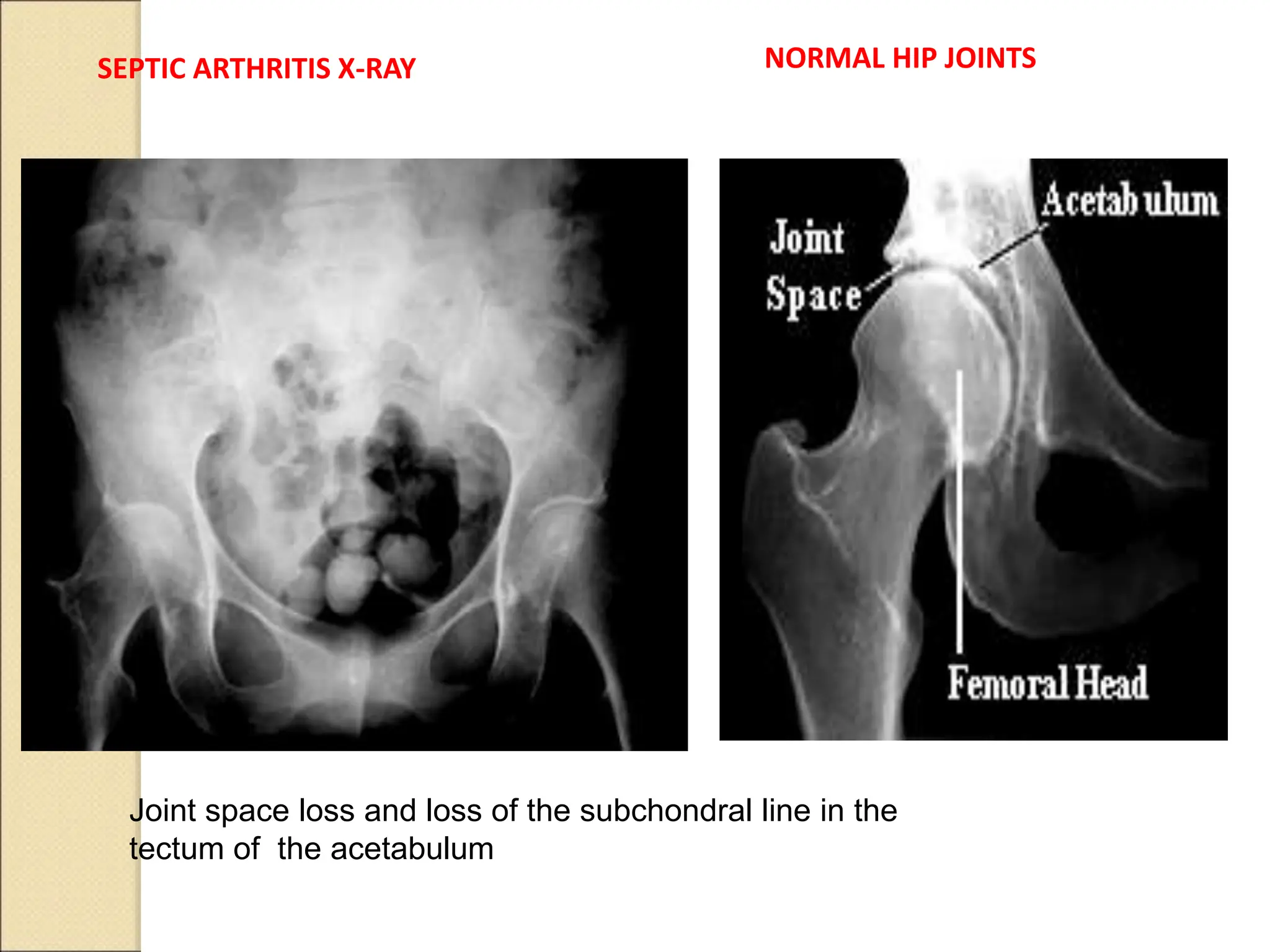 arthritis.ppt