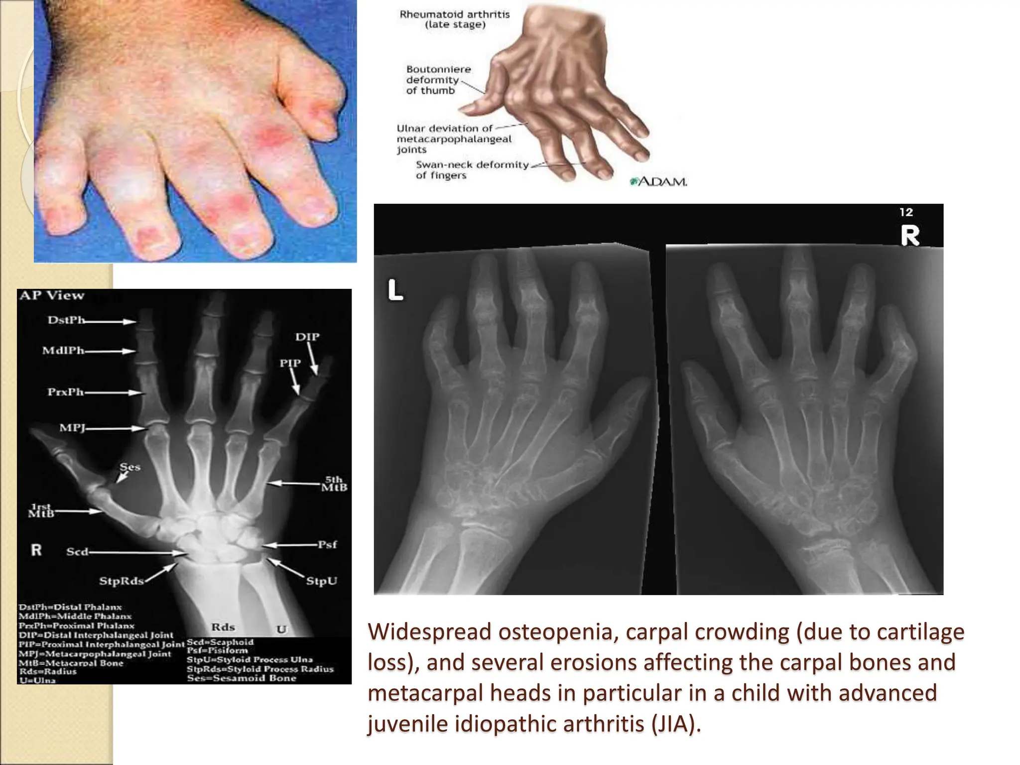 arthritis.ppt