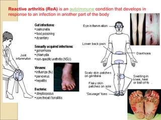 arthritis.ppt