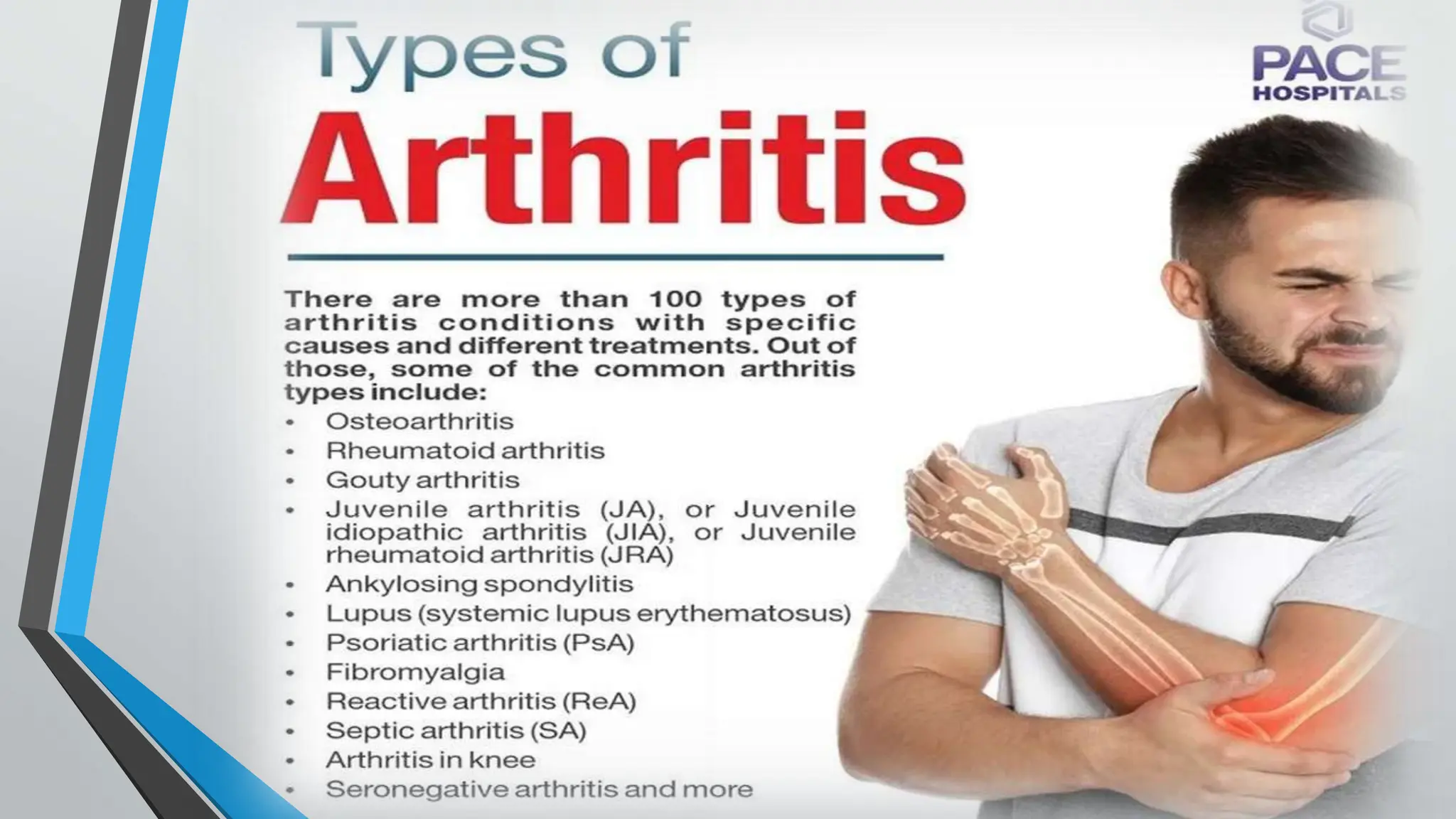 Arthritis Joints are places where two bo | PPT