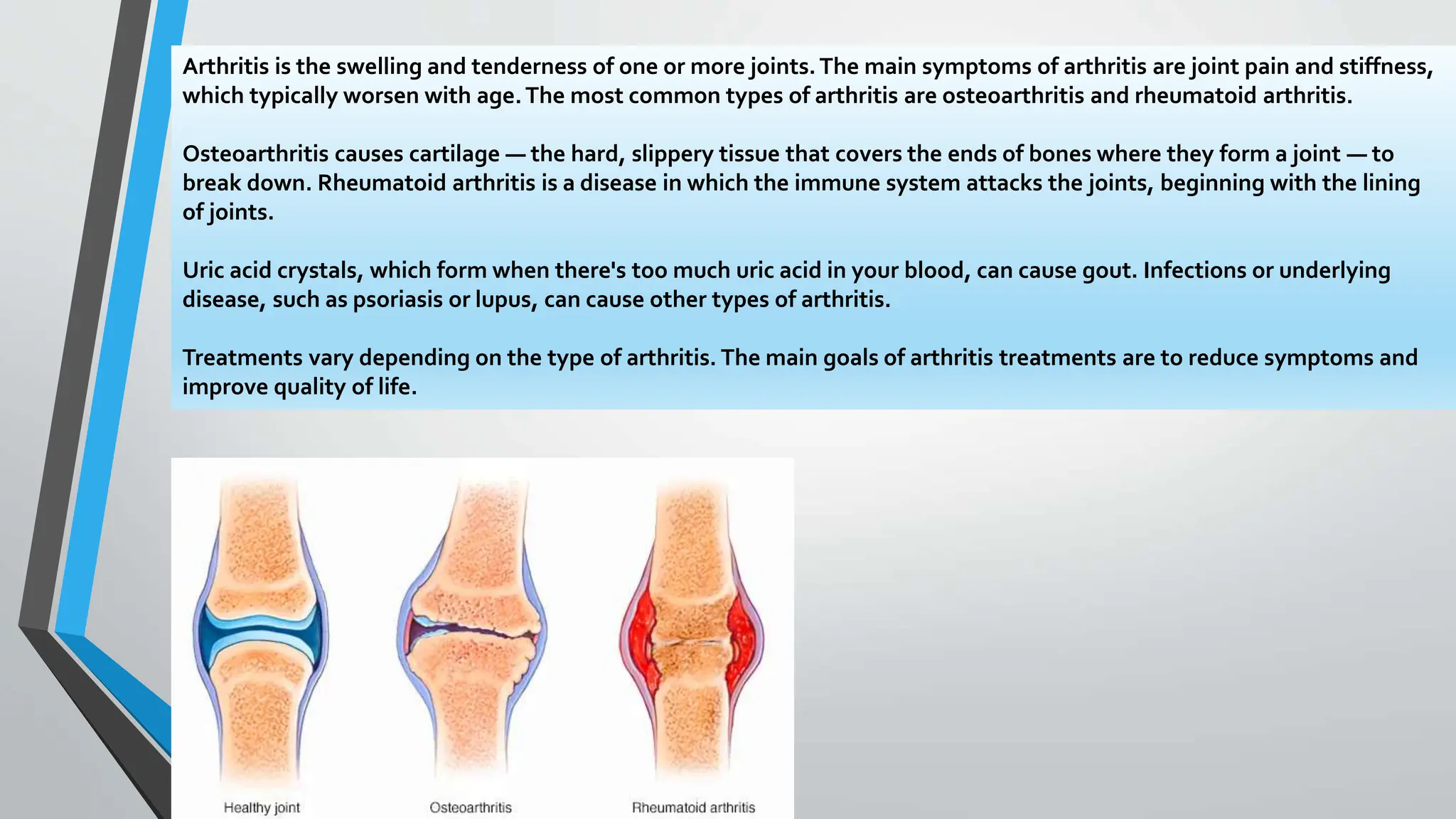 Arthritis Joints are places where two bo | PPT