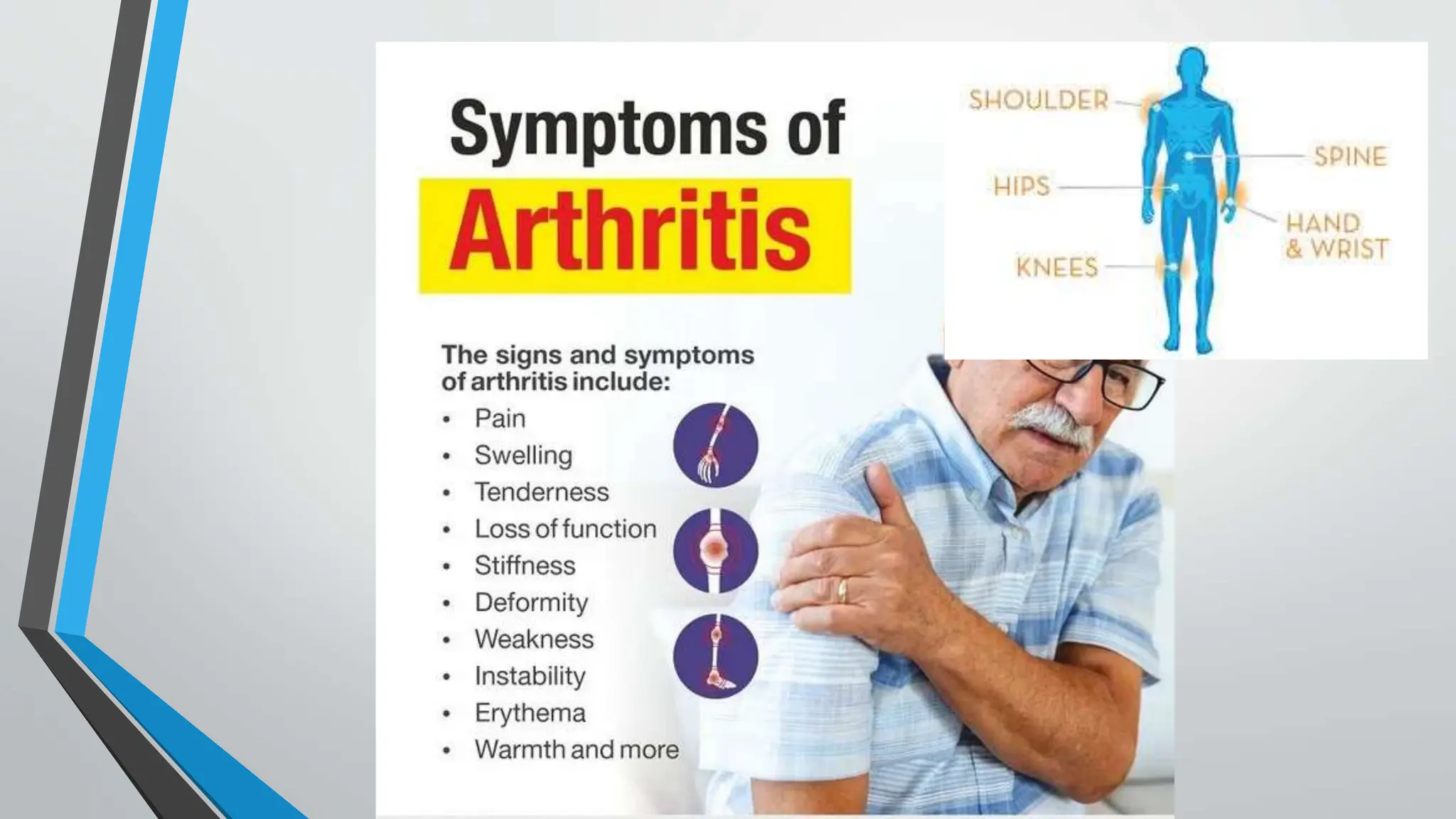 Arthritis Joints are places where two bo | PPT