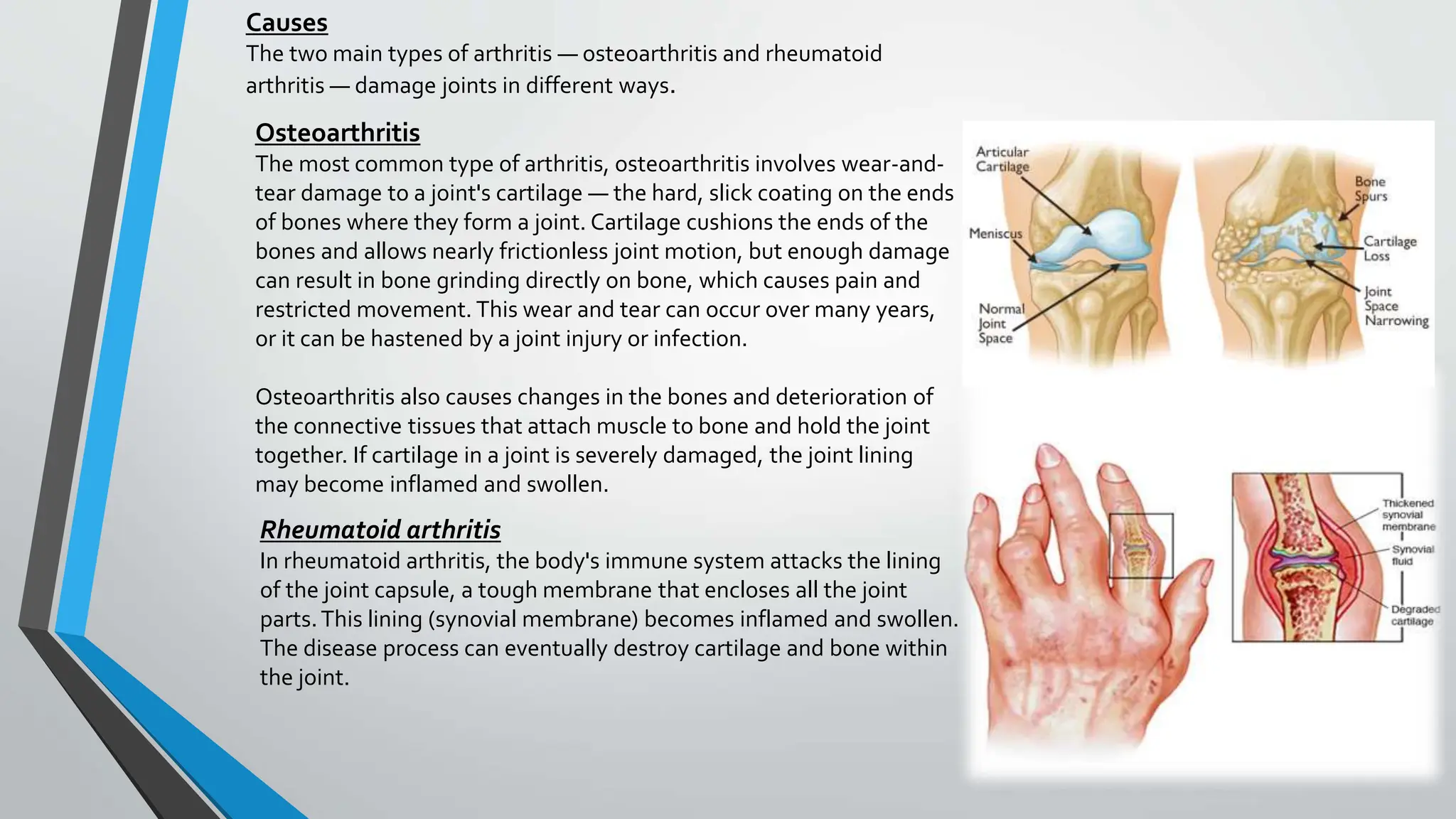 Arthritis Joints are places where two bo | PPT