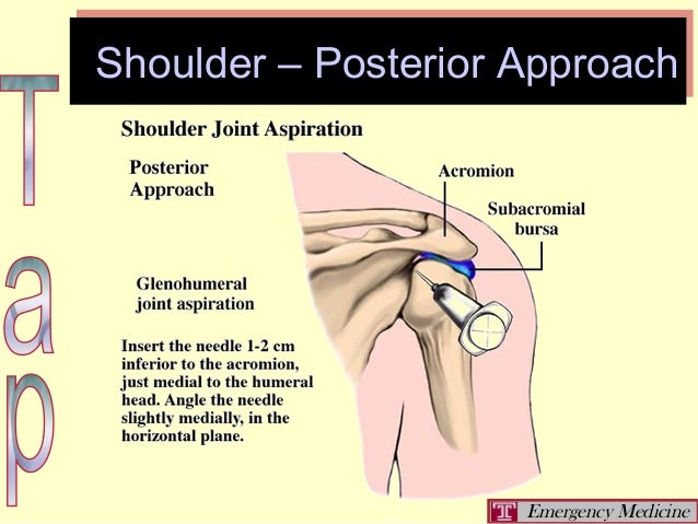 Arthritis and Arthrocentesis