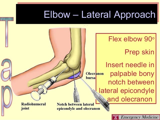 Arthritis and Arthrocentesis