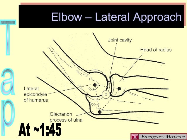 Arthritis and Arthrocentesis