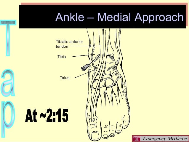 Arthritis and Arthrocentesis