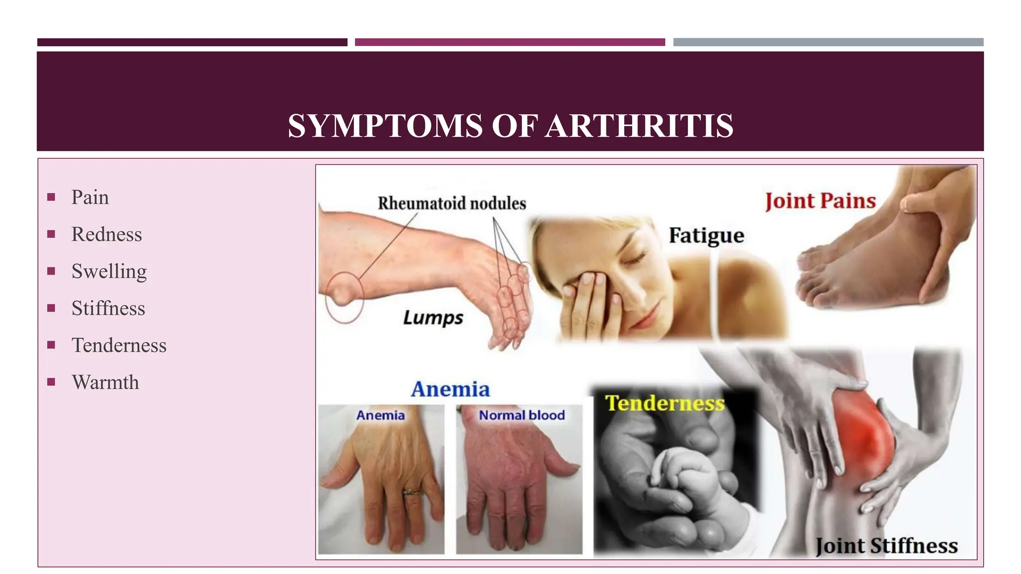 Arthritis and it's most common types with diet management and ...