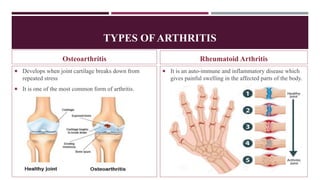 Arthritis and it's most common types with diet management and ...
