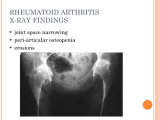 Arthritis | PPT
