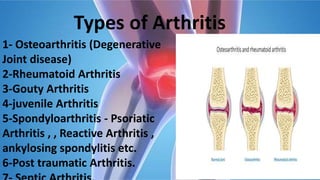 Arthritis , Types , it's Etiolopathology , clinical features and ...