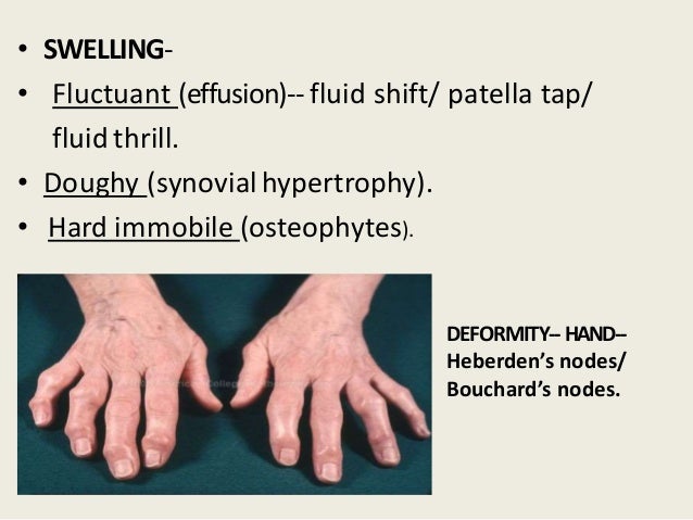Heberdens Nodes Predict Knee Oa Progression Rheumnow