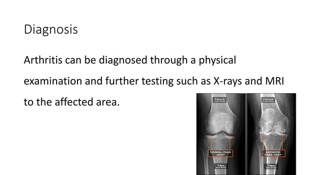 A powerpoint presentation on Arthritis.. | PPTX | Physical Therapy ...