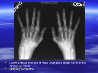 Arthritis of the hands | PPT