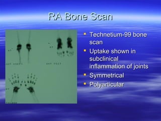 Arthritis of the hands | PPT