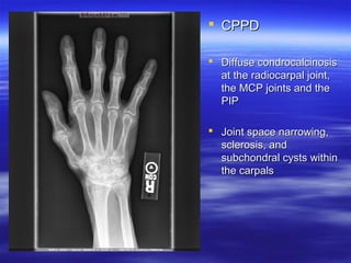 Arthritis of the hands | PPT