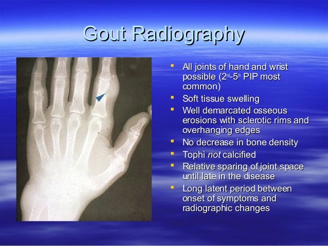 Arthritis of the hands