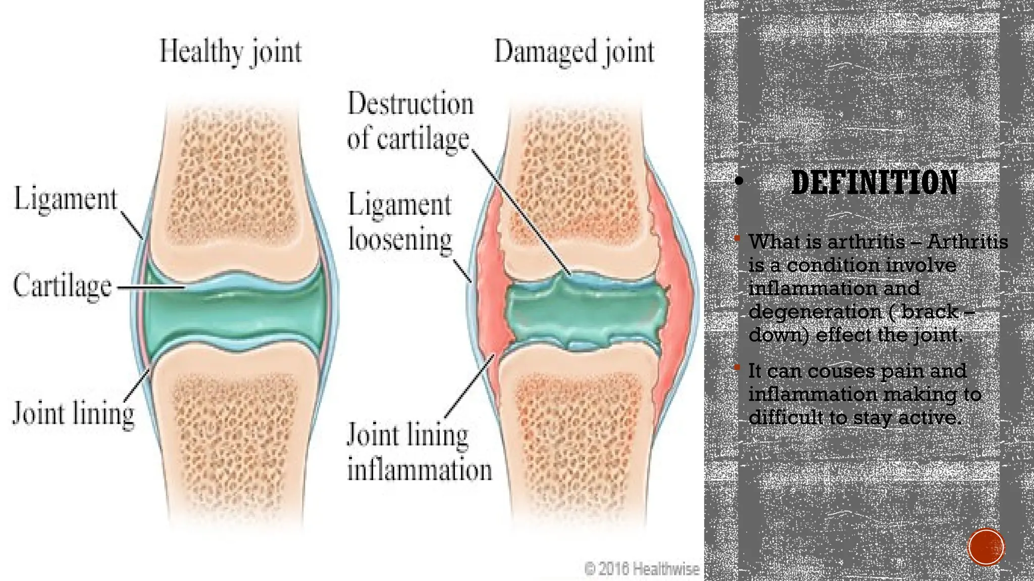 Arthritis itself is a general term for a group of inflammatory and ...