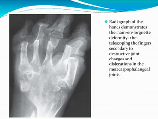 Arthritis ppt dr ankit | PPTX