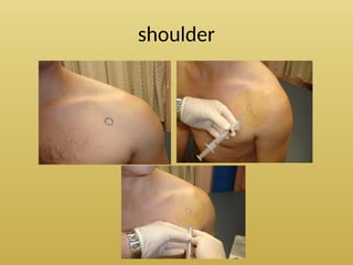 TECNICA DE ARTROCENTESIS REALIZACION Y COMPLICACIONES | PPTX