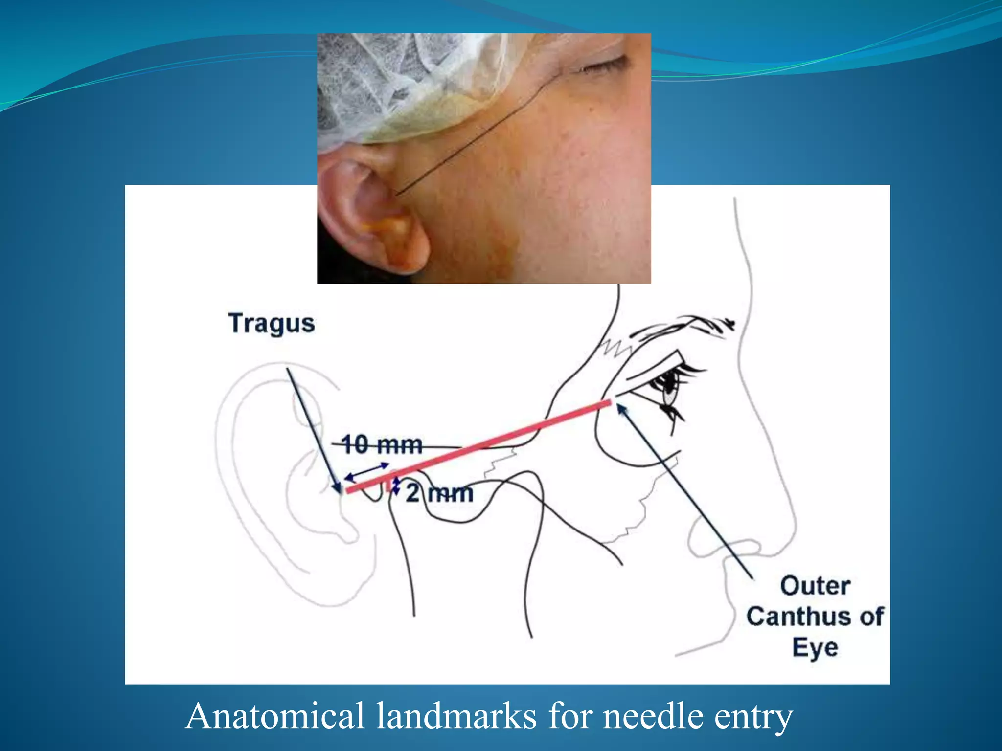 Arthrocentesis of the temporomandibular joint | PPTX