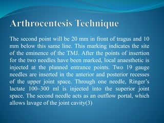 Arthrocentesis of the temporomandibular joint | PPTX