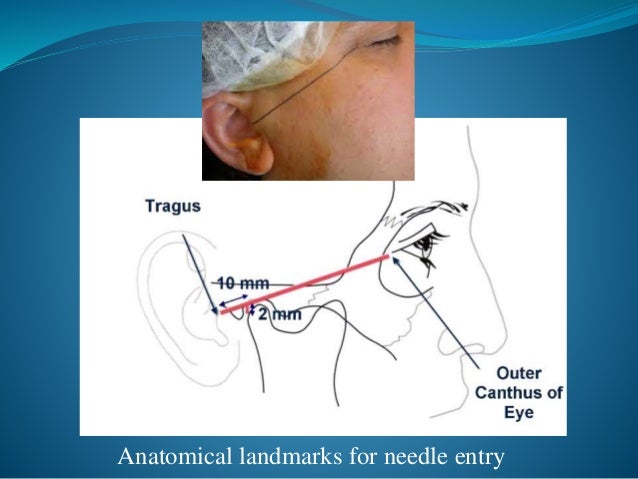 Arthrocentesis of the temporomandibular joint