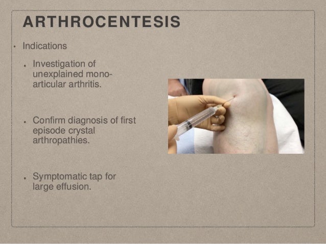 arthrocentesis 中文 – Chisoku