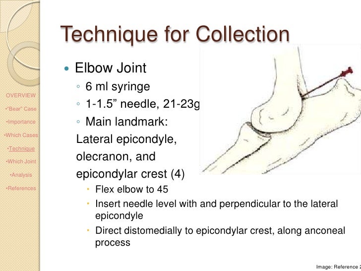 Arthrocentesis Presentation Katie Krimetz Core Surgery